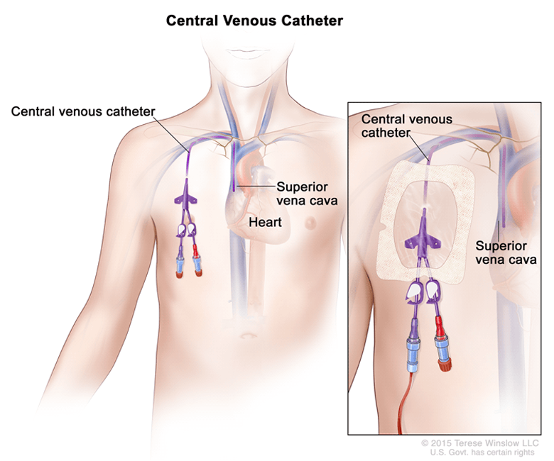 Mengukur Central Venous Pressure Dari Indikasi Sampai Peran Perawat